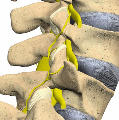 Arthritis or Spinal Facet Syndrome - Wasatch Pain Solutions